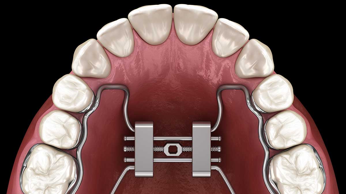 Lower Arch Expander